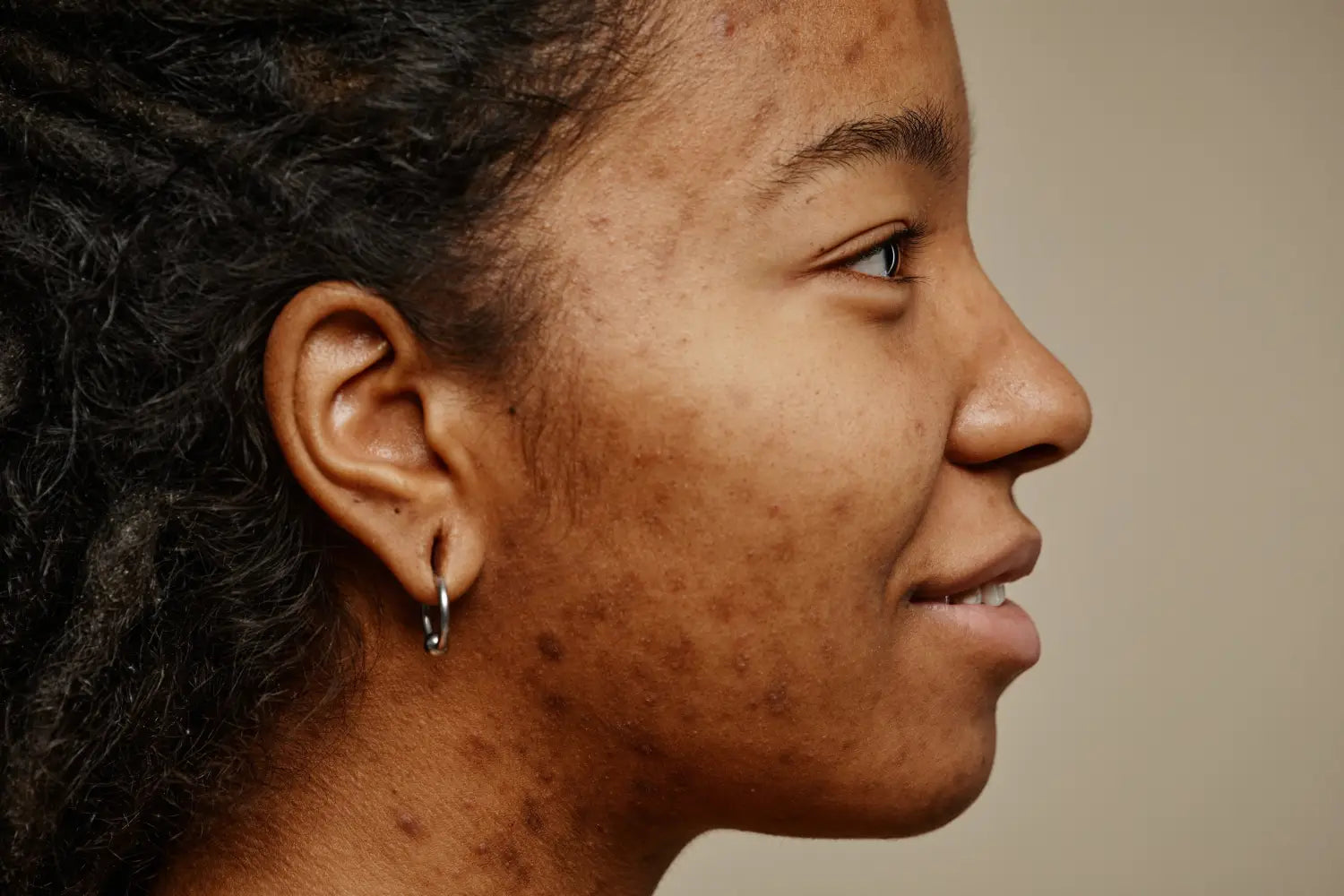Best Products For Hyperpigmentation – Dermaflage Store