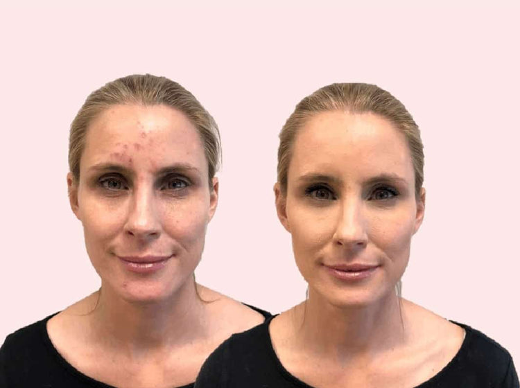 Tattoo, Acne, Wrinkles and Scar Cover Up Makeup | Dermaflage ...